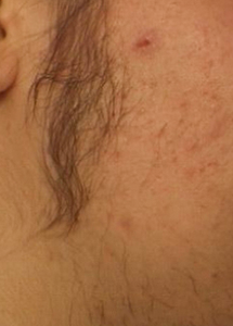 Facial Hair Refine Laser - EosIce®